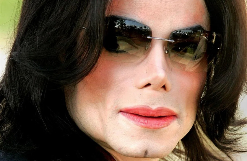 Vitiligine: la malattia di Michael Jackson - laCOOLtura